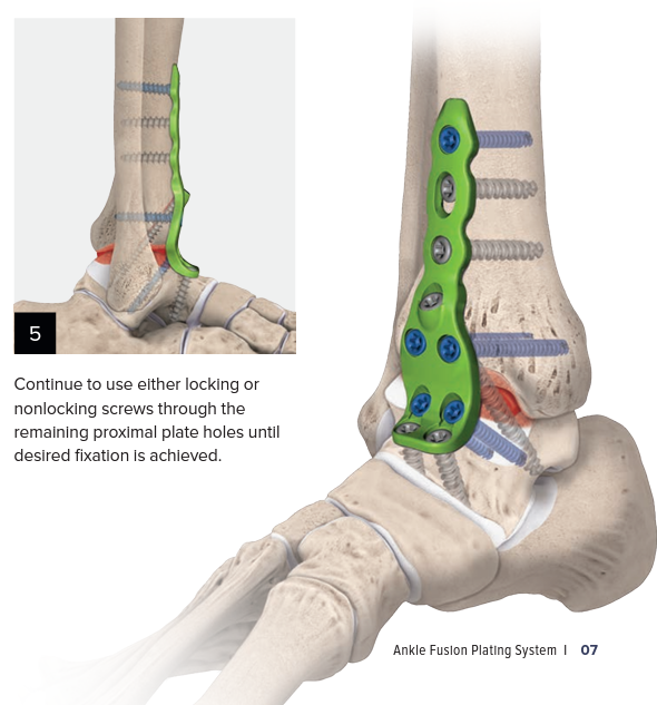 Ankle-Arthrodesis (AA) Tibio-talar fusion 발목관절 유합술 : 네이버 블로그