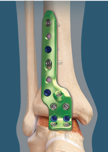 Ankle-Arthrodesis (AA) Tibio-talar fusion 발목관절 유합술 : 네이버 블로그