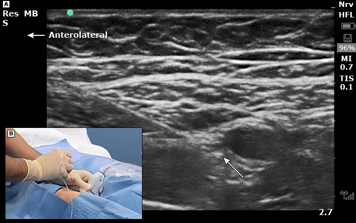 초음파 유도하 Adductor canal block (saphenous nerve block)에 관하여. : 네이버 블로그