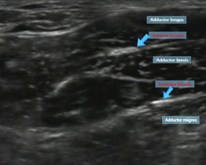 obturator nerve block 폐쇄신경 차단술, 초음파 유도하 신경차단술 방법과 팁 : 네이버 블로그
