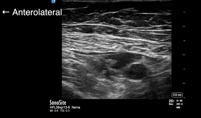 초음파 유도하 Adductor canal block (saphenous nerve block)에 관하여. : 네이버 블로그