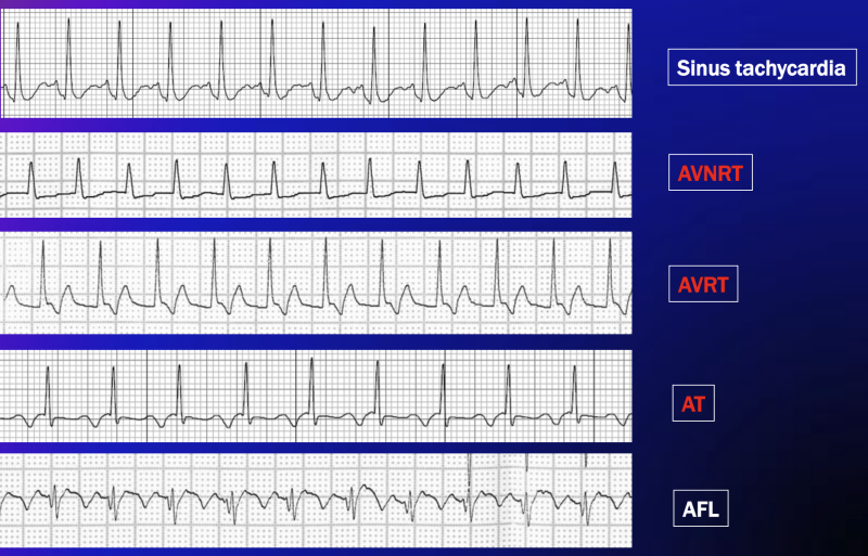 심전도 ECG/EKG SVT(1) - AVNRT, AVRT : 네이버 블로그
