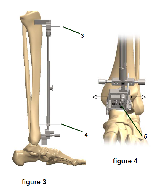 Ankle-TAA (Total Ankle Arthrosplasty)-TARIC ImplantCast 족관절 인공관절치환술 ...