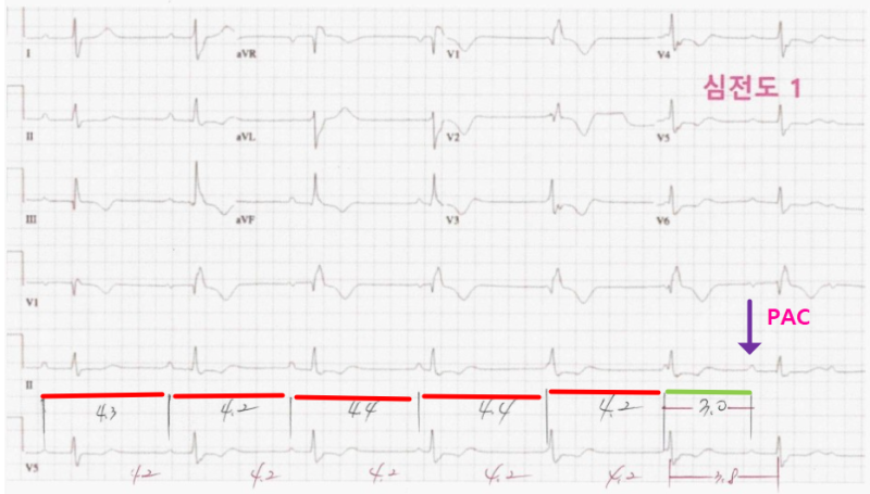 심전도, High grade AV block, Complete AV block, AF with complete heart ...