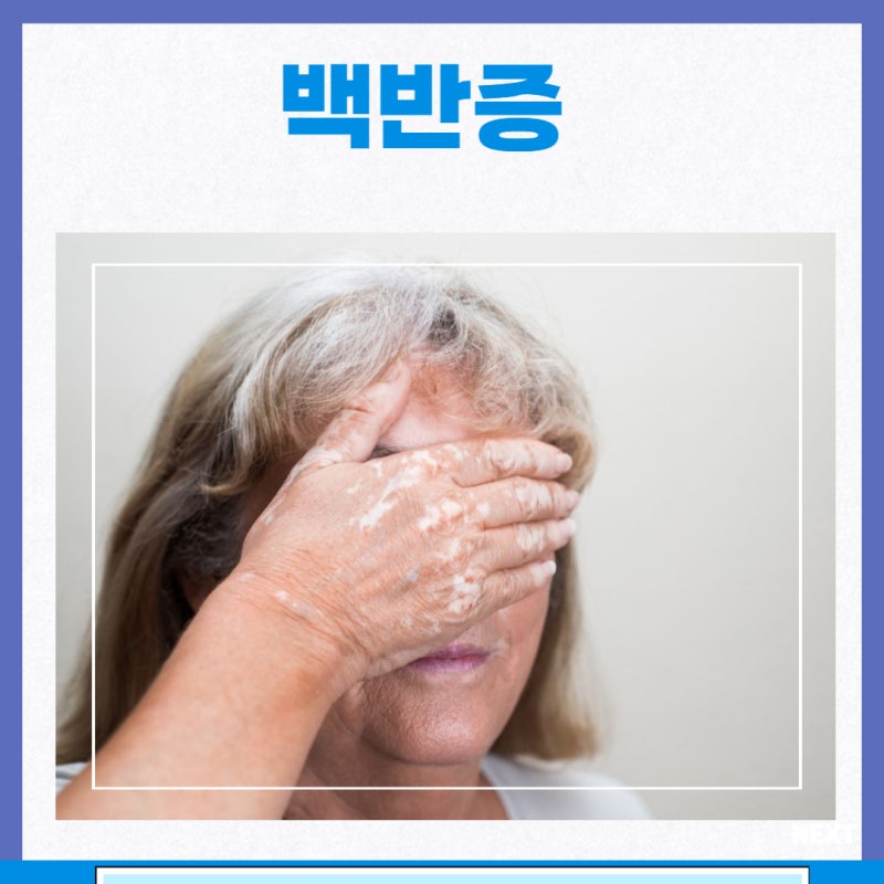 백반증 증상 원인 치료 백색증 원인 증상 백색비강진 네이버 블로그