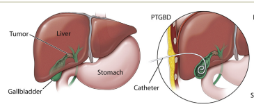 PTBD, PTGBD 차이점과 시술 방법 : 네이버 블로그