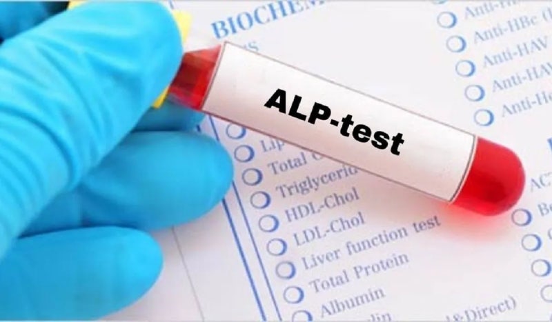 연령대별 ALP 간기능 수치 총정리(ALP normal range by age) : 네이버 블로그