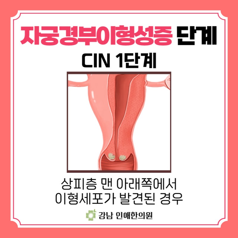 자궁경부이형성증 원인 증상 비교 단계별 치료 방법 네이버 블로그