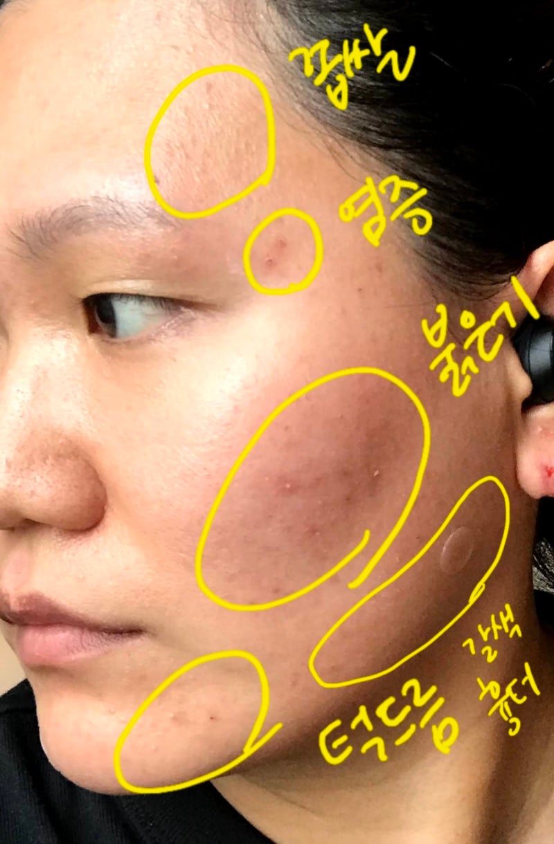 8년간의 여드름으로 알게 된 여드름 교훈 광고없는 스킨케어 블로그 여드름 극복 관리팁 네이버 블로그