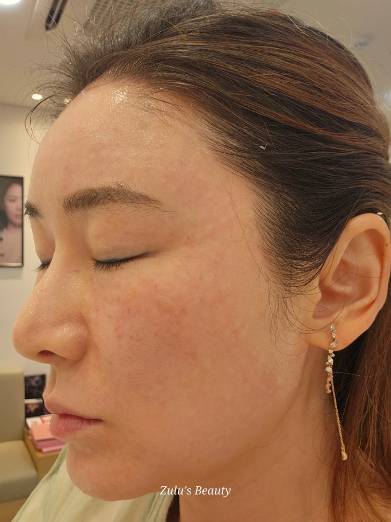 건성피부 피부과관리 추천 리쥬란 후 릴리 물광주사 연어주사 효과 강남피부과 릴리이드m 가격 엠보싱 주기 후기 네이버 블로그