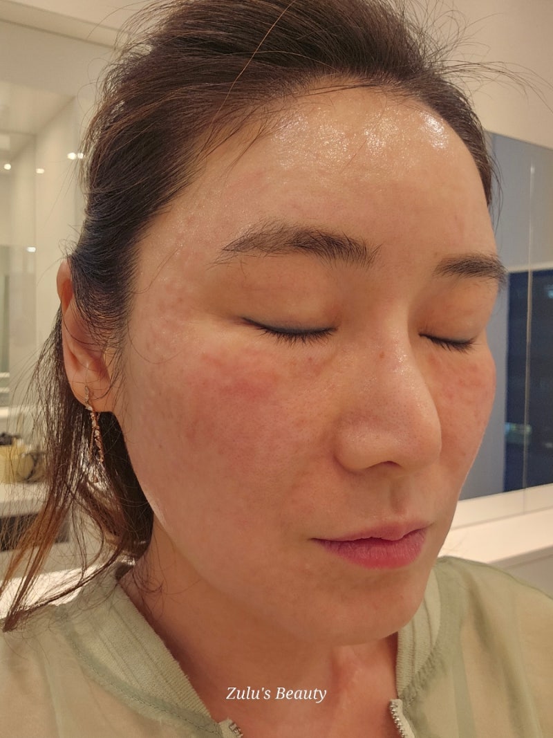 건성피부 피부과관리 추천 리쥬란 후 릴리 물광주사 연어주사 효과 강남피부과 릴리이드m 가격 엠보싱 주기 후기 네이버 블로그