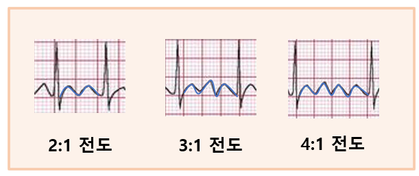 심방조동 (Atrial flutter, 의학용어 AFL) 심전도 EKG, 증상, 임상적 의미, 치료 : 네이버 블로그