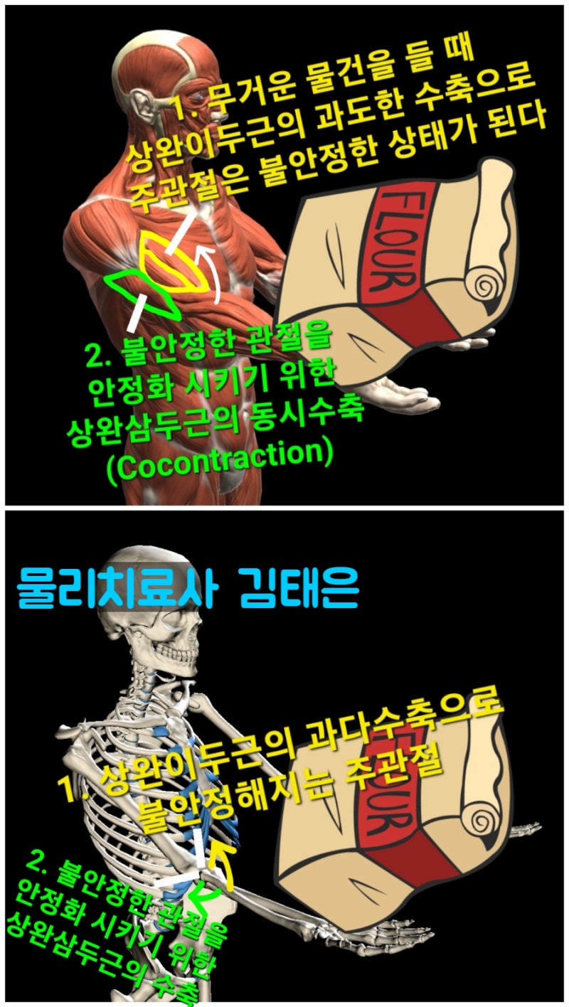 팔이 저려요 요골신경 포착radial Nerve Entrapment Ulttupper Limb Tension