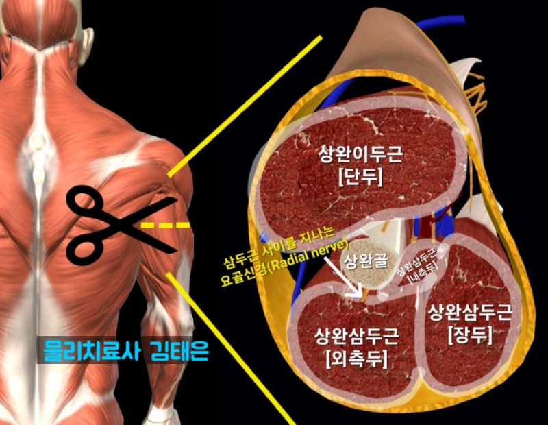 팔이 저려요 - 요골신경 포착(Radial nerve entrapment) - ULTT(Upper limb tension ...