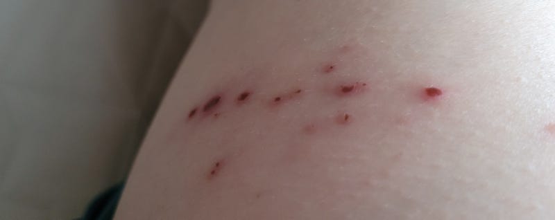 임산부 대상포진 후기 테라마이신안연고 네이버 블로그