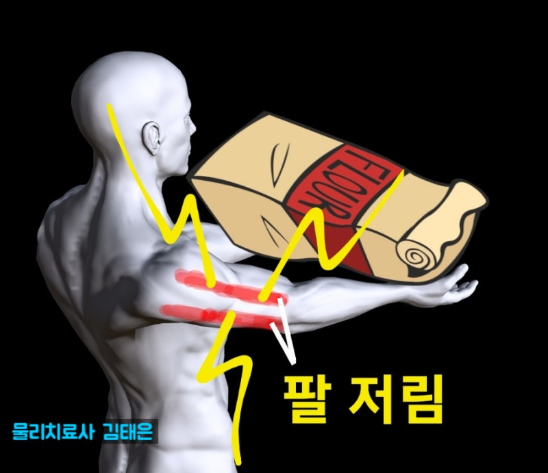 팔이 저려요 - 요골신경 포착(Radial nerve entrapment) - ULTT(Upper limb tension ...