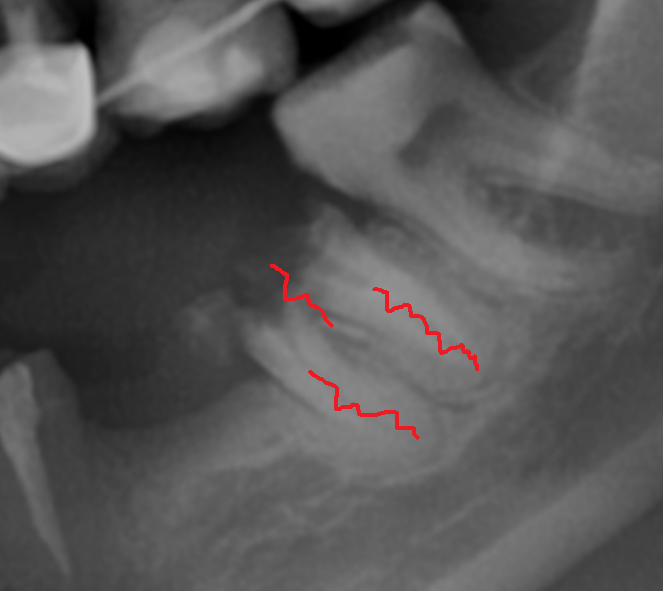 [증례] Hypercementosis(과백악질화)된 Root rest(잔존 치근)의 발치 : 네이버 블로그
