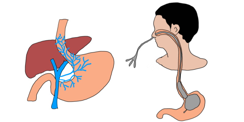 SB tube(Sengstaken - blakemore tube)의 모든 것 : 네이버 블로그