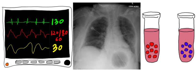 SB tube(Sengstaken - blakemore tube)의 모든 것 : 네이버 블로그