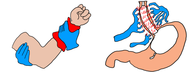 SB tube(Sengstaken - blakemore tube)의 모든 것 : 네이버 블로그