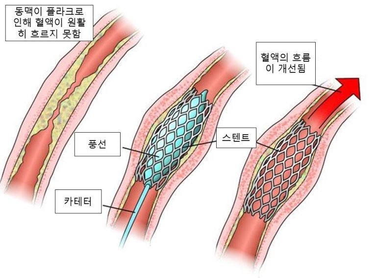 의학용어 Cag Pci 관상동맥조영술 경피적관상동맥중재술 목적시술 과정 시술 전후 간호 네이버 블로그
