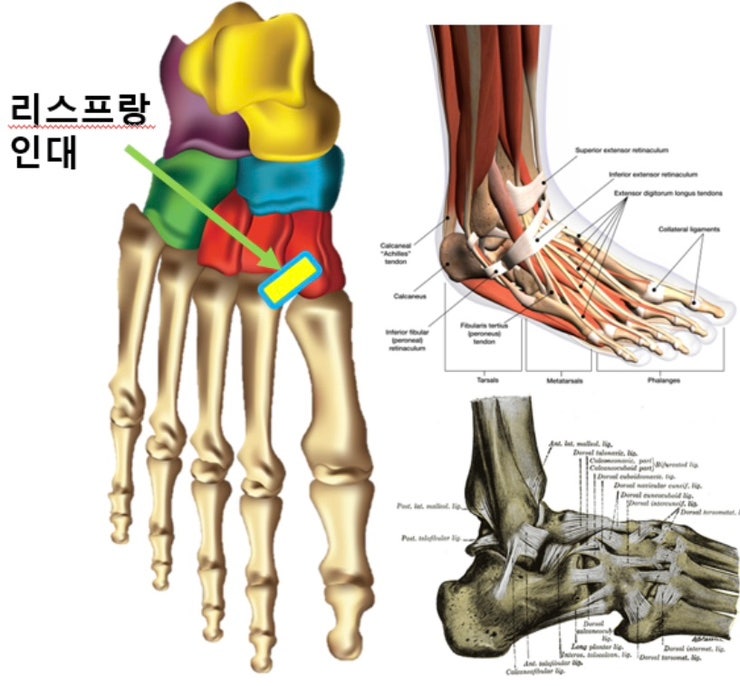 리스프랑 인대 발등 인대 부분파열⚡️ 네이버 블로그