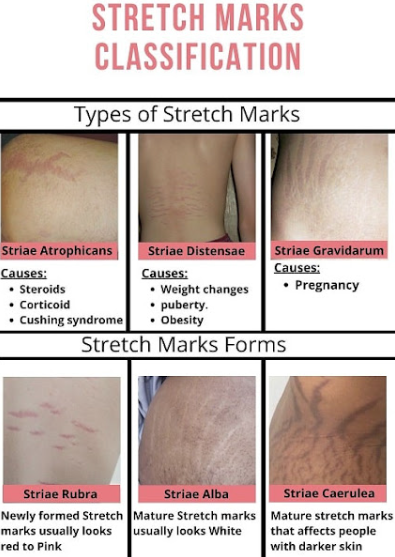 피부과 전문의와 알아보는 튼살(Stretch Mark, Striae) 해결방법 : 네이버 블로그