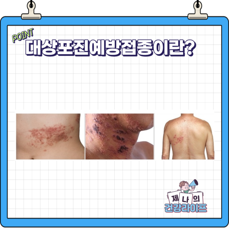 대상포진 예방접종 싱그릭스 가격과 부작용 접종 간격 횟수 네이버 블로그