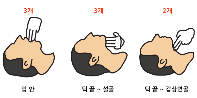 응급상황에서의 기관삽관(Intubation) : RSI(Rapid Sequence Intubation) : 네이버 블로그