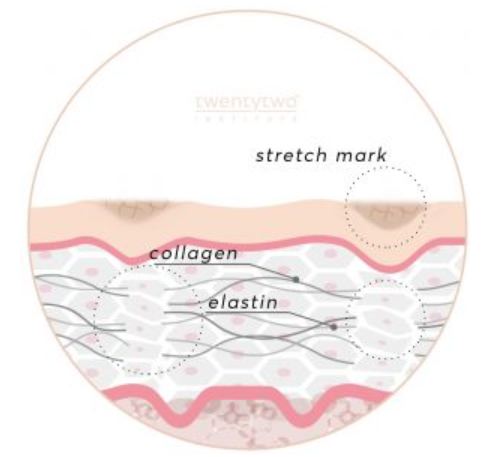 피부과 전문의와 알아보는 튼살(Stretch Mark, Striae) 해결방법 : 네이버 블로그