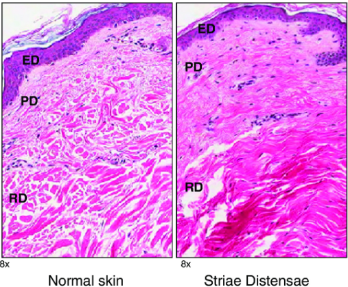 피부과 전문의와 알아보는 튼살(Stretch Mark, Striae) 해결방법 : 네이버 블로그