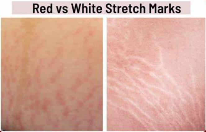 피부과 전문의와 알아보는 튼살(Stretch Mark, Striae) 해결방법 : 네이버 블로그