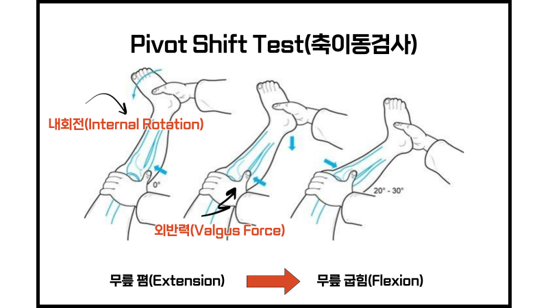 pivot shift test(축이동검사) / 전방십자인대 손상,파열 검사, 무릎 회전 안정성 검사 / 무릎 이학적 검사 ...