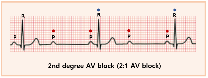 방실차단 (AV block) 심전도, 치료, 방실결절 (AV node) 이하 전도지연,1,2,3도, 완전 Complete ...