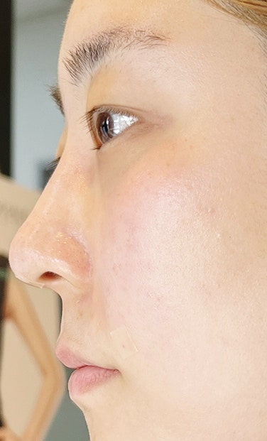 논현역피부과 큐티필 feat. 팔자주름필러 + 콧대필러 + 보톡스 대만족 후기 : 네이버 블로그