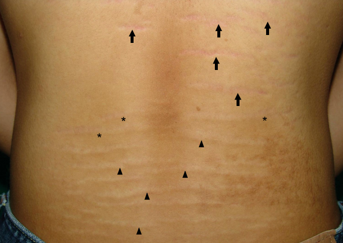 피부과 전문의와 알아보는 튼살(Stretch Mark, Striae) 해결방법 : 네이버 블로그