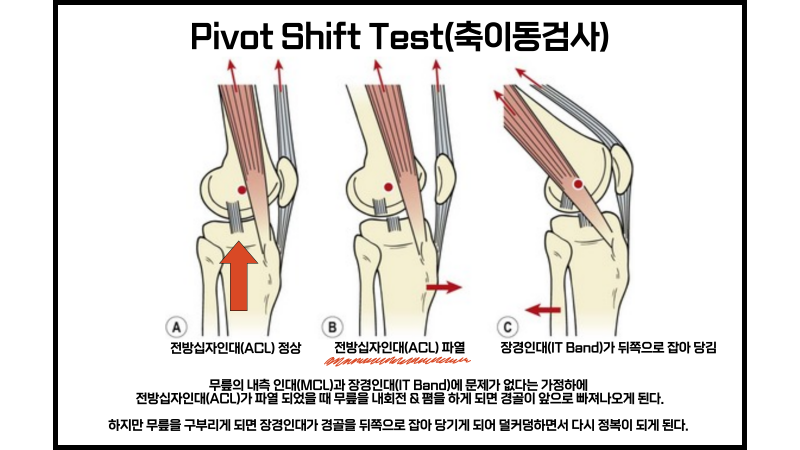 pivot shift test(축이동검사) / 전방십자인대 손상,파열 검사, 무릎 회전 안정성 검사 / 무릎 이학적 검사 ...
