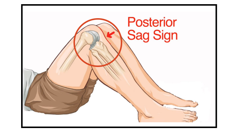 Posterior Drawer Test(후방 전위 검사) / 후방십자인대 파열 및 손상 검사, 무릎 불안정성 검사, 무릎 이학적 ...
