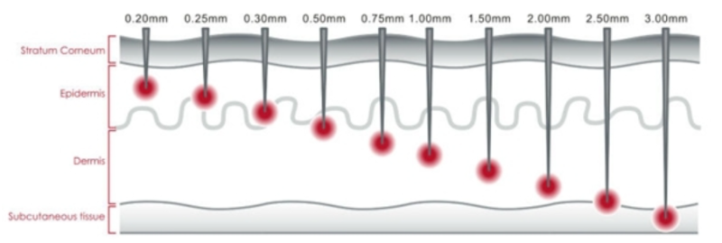 피부과 전문의와 알아보는 튼살(Stretch Mark, Striae) 해결방법 : 네이버 블로그