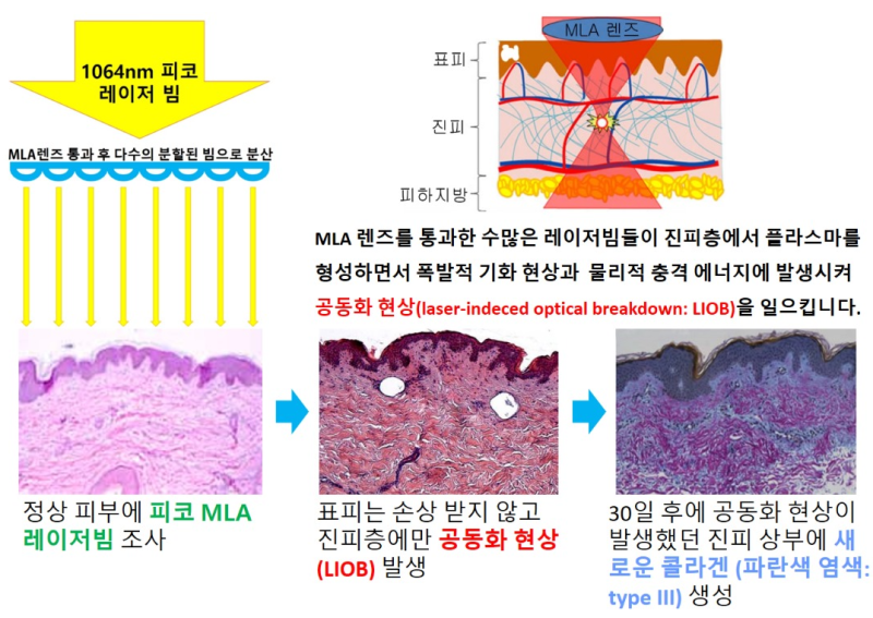피부과 전문의와 알아보는 튼살(Stretch Mark, Striae) 해결방법 : 네이버 블로그