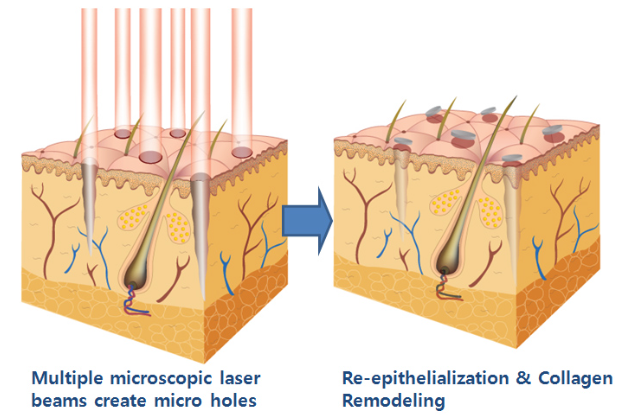 피부과 전문의와 알아보는 튼살(Stretch Mark, Striae) 해결방법 : 네이버 블로그