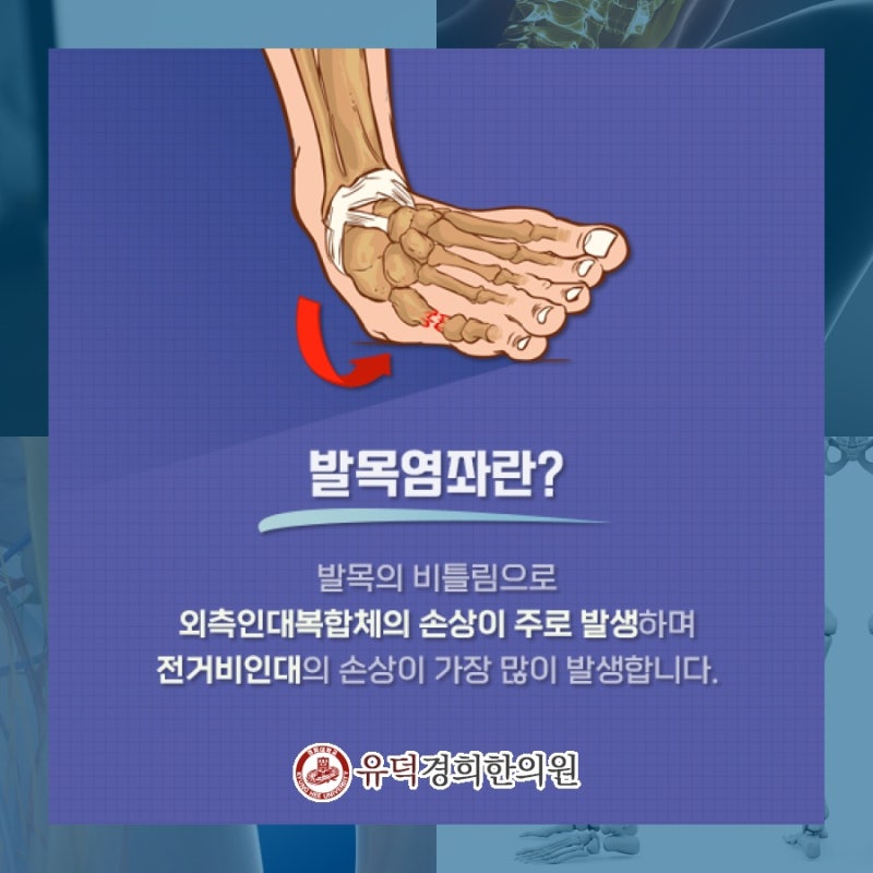 헛디딘 발목염좌에는 Price 응급처치 필수 만안구 안양역한의원 추나요법 한방재활의학과전문의 네이버 블로그
