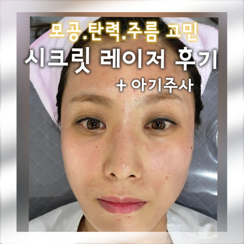넓은모공 시크릿 레이저 3회차 시술후기 아기주사눈밑보톡스 효과 및 부작용모공축소프락셀 네이버 블로그
