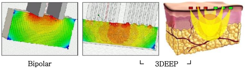 쓰리딥리프팅 3deep 셀프시술후기 (원리/효과,부작용/통증,가격/울쎄라 써마지 인모드 비교) : 네이버 블로그
