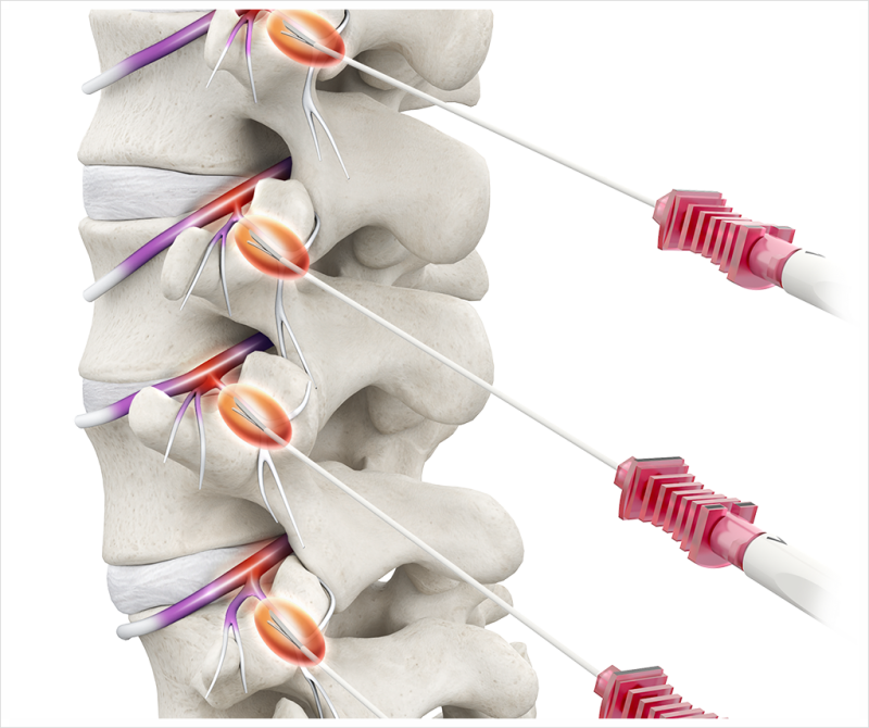 척추 고주파 열응고술(RF) 급여기준과 비용 Radiofrequency Ablation of Spine : 네이버 블로그
