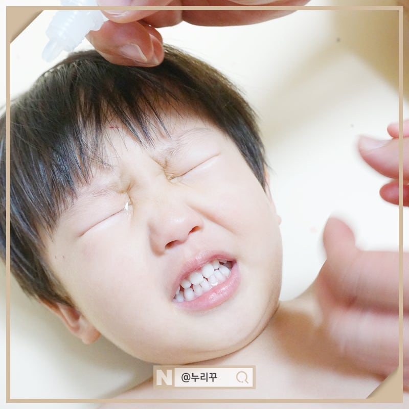 요즘 유행 아기 눈꼽감기 아데노바이러스 증상 미열 눈 안약 넣는법 전염 등원 여부 네이버 블로그
