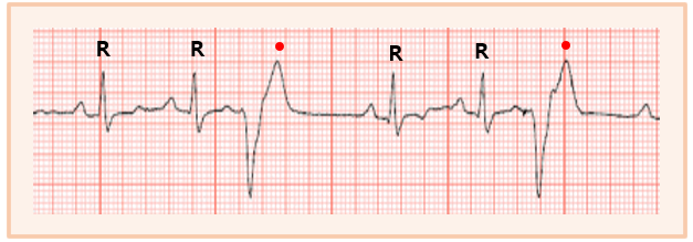 심실조기 수축 (의학용어 VPC PVC Ventricular premature beat)에 대한 정리 한번에 보기 : 네이버 블로그
