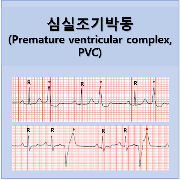 심실조기 수축 (의학용어 VPC PVC Ventricular premature beat)에 대한 정리 한번에 보기 : 네이버 블로그