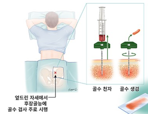 의학용어 Bone Marrow Biopsy And Aspiration 골수생검 골수천자 방법 위치 간호 혈액질환진단 네이버 블로그