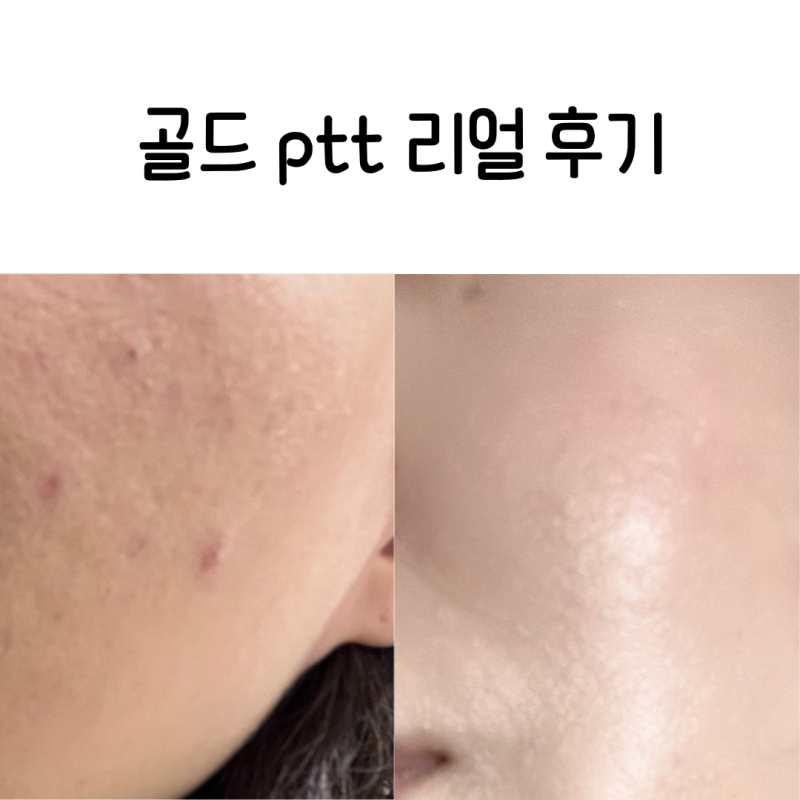 압구정 피부과 여드름 골드 Ptt 1회차 후기 치료 가격 효과 네이버 블로그